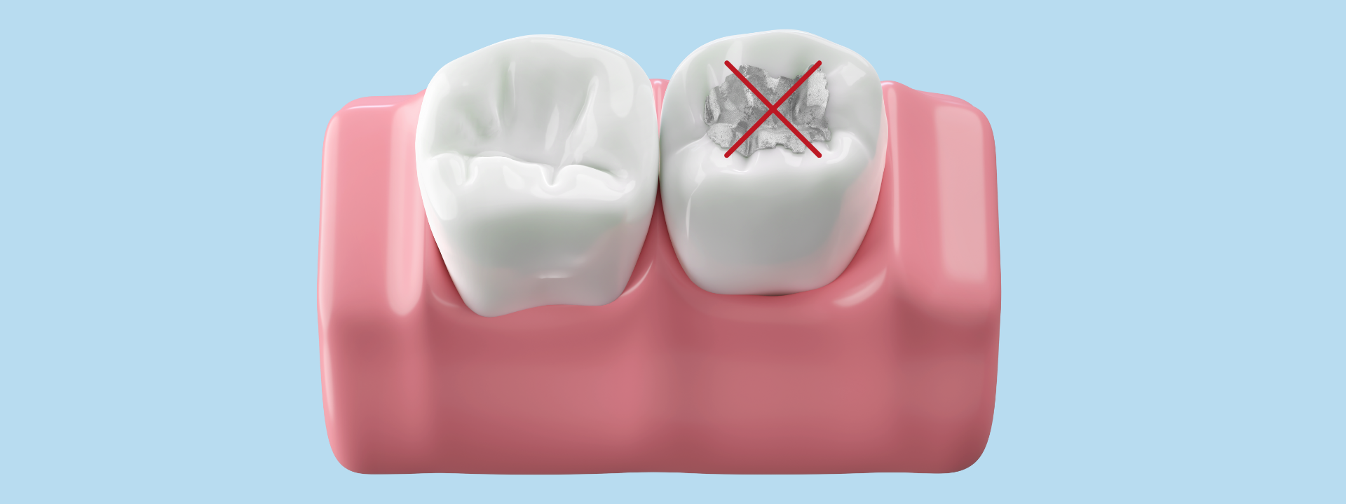 Amalgam ban 2025: The best alternatives for dental fillings